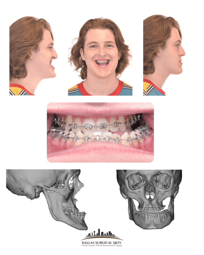 Jaw Repositioning (Orthognathic Surgery) | Dallas Surgical Arts